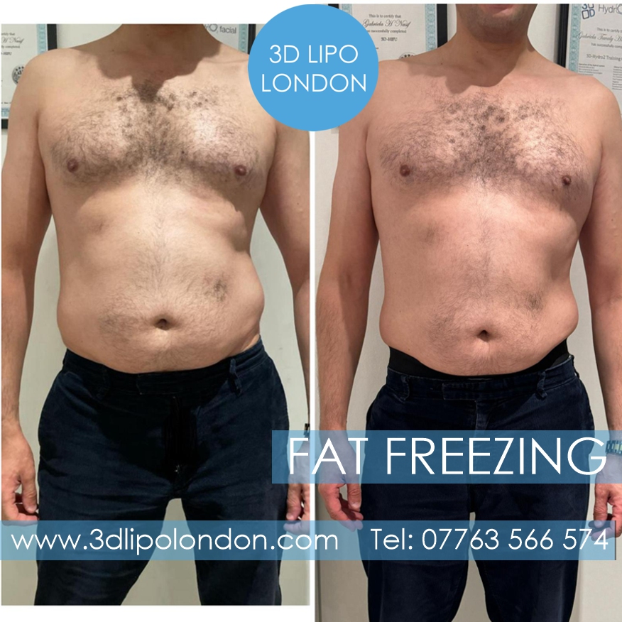 Fat Freezing Treatment in London