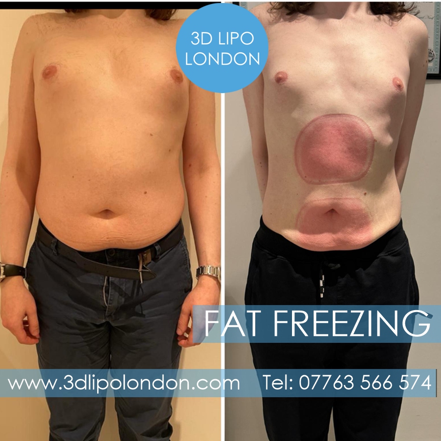 3d Lipo london - Before and After Results