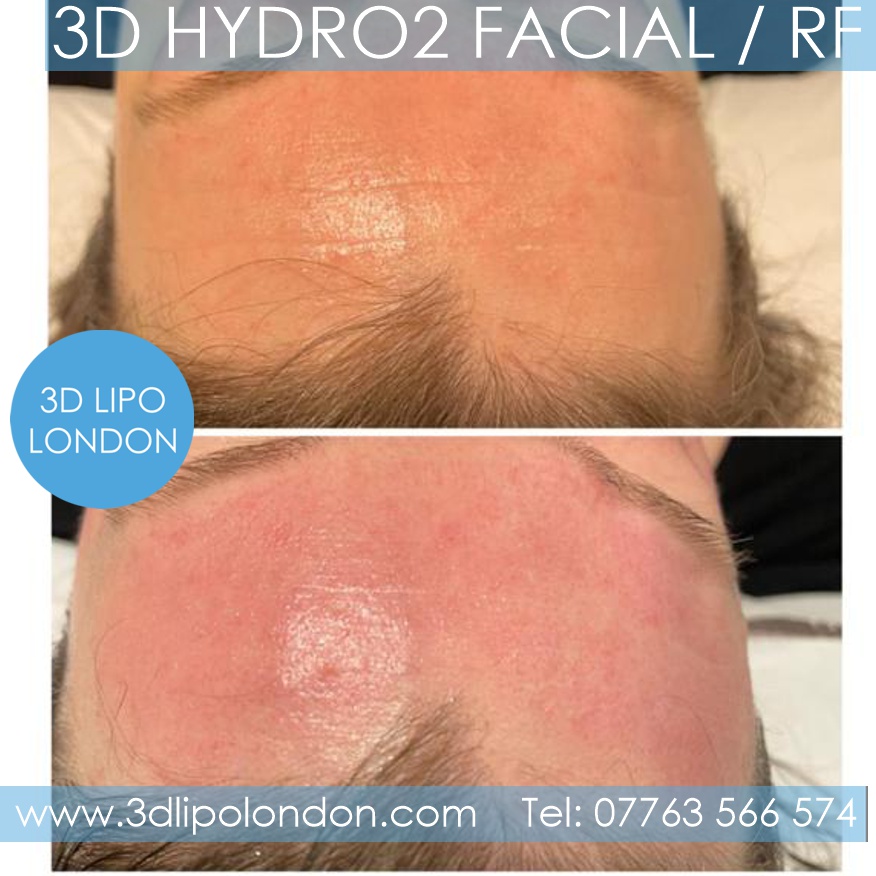 Fat freezing Before and After Results